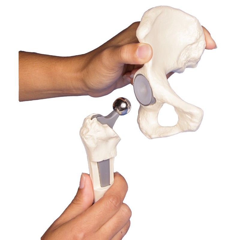 Hip Implant Model | Health and Care